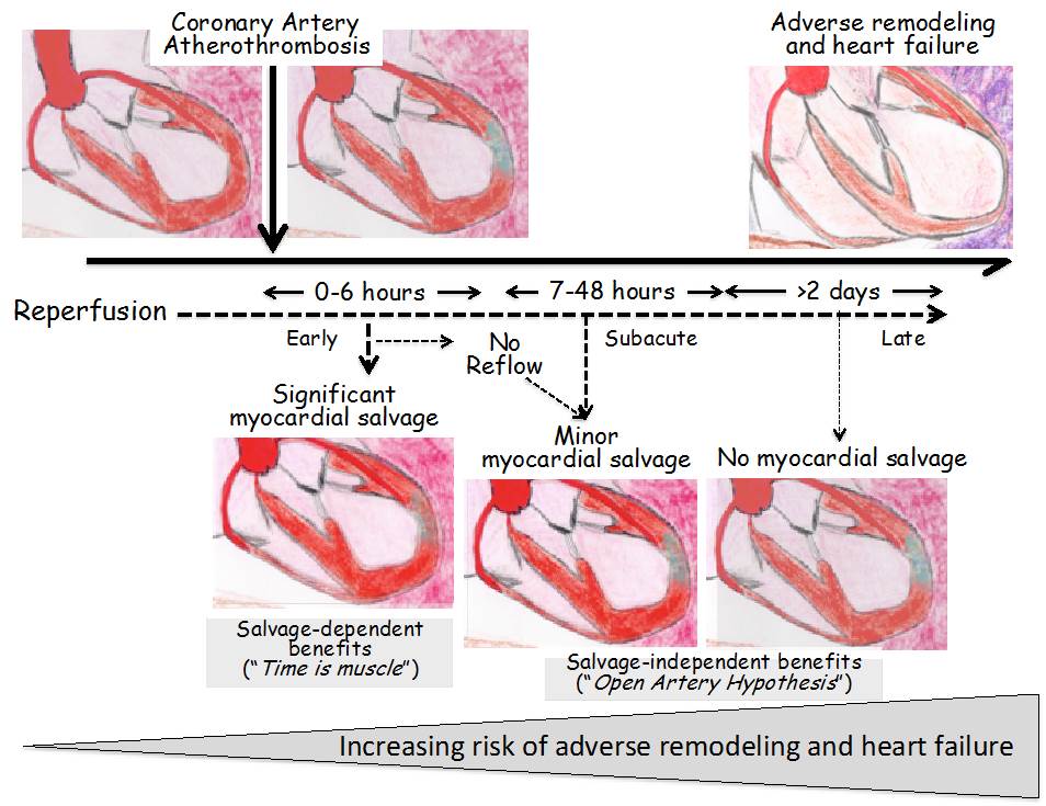 Causes and Prevention of Ventricular Remodeling After MI - American College of Cardiology